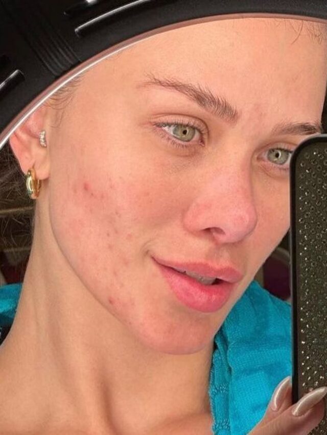 Flávia Pavanelli fala sobre sua trajetória com a acne - Vitat